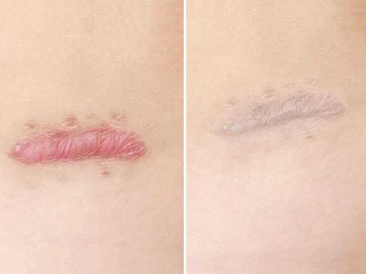 How to Treat Scars Due to Motorcycle Injuries - VikingBags