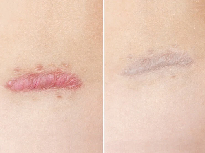 How to Treat Scars Due to Motorcycle Injuries - VikingBags